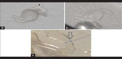 Transscleral Fixation Of Closed Loop Haptic Acrylic Posterio