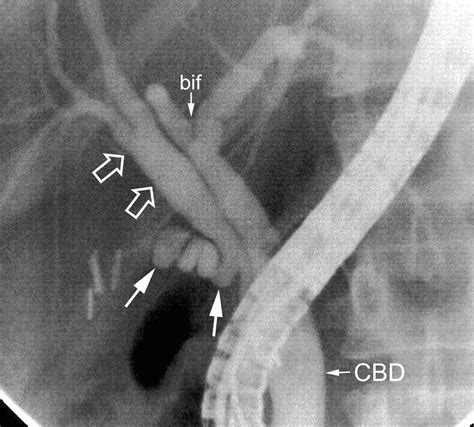 Congenital Anomalies And Normal Variants Of The Pancreaticobiliary