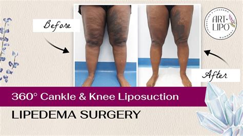 360° Cankle And Knee Lipedema Liposuction Results In 1 Day Artlipo