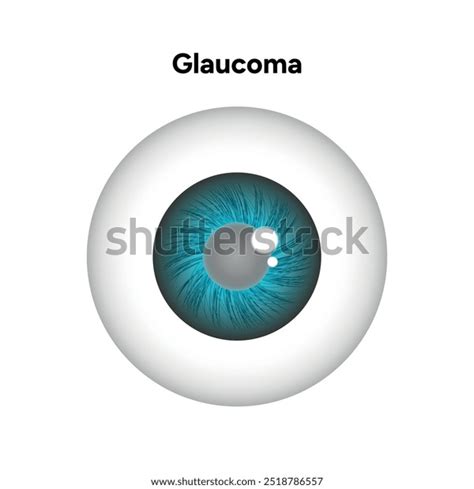 Eye Structure Defect Eye Glaucoma Stock Vector Royalty Free