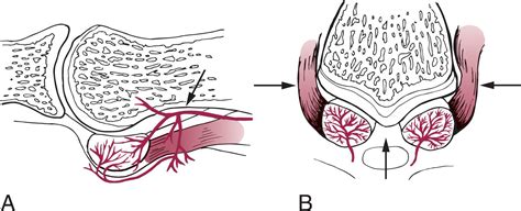Sesamoids And Accessory Bones Of The Foot Clinical Tree