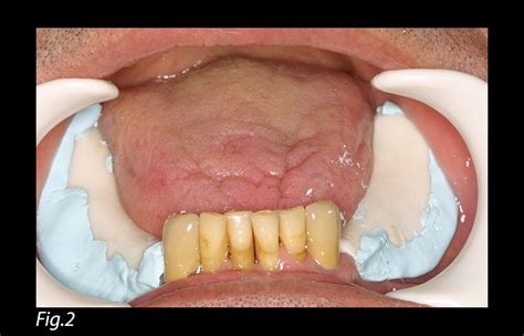 A Simplified Impression Technique For Distal Extension Removable Partial Dentures