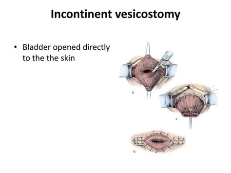 Cutaneous Urinary Stoma Pptx Digestive Disorders Diseases And