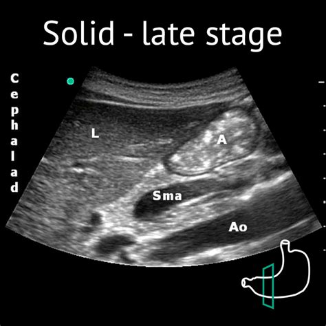 Gastric Ultrasound • Image Gallery