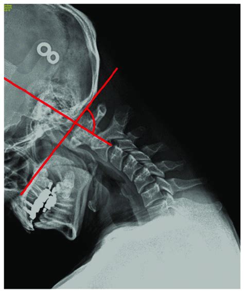 Measurement Of Upper Cervical Flexion Angle Using X Ray Download Scientific Diagram