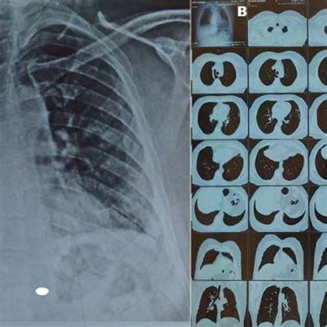 A Honeycomb Appearance Of Bronchiectasis Is Evident In Left Upper