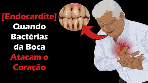 Endocardite Bacteriana Causas E Sintomas Da Infecção Cardíaca Por Bactérias Orais