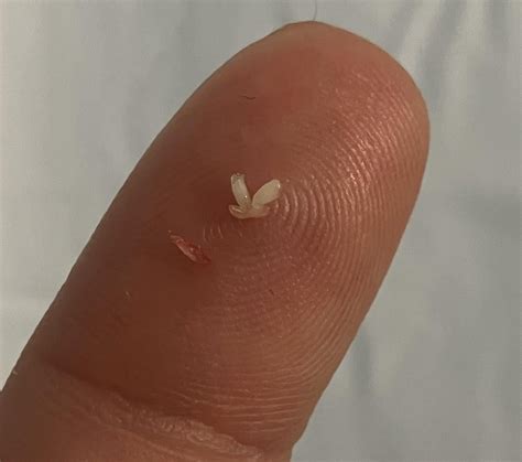 I Asked 3 Days Ago Just Extracted This Double Plug Is This Warts R