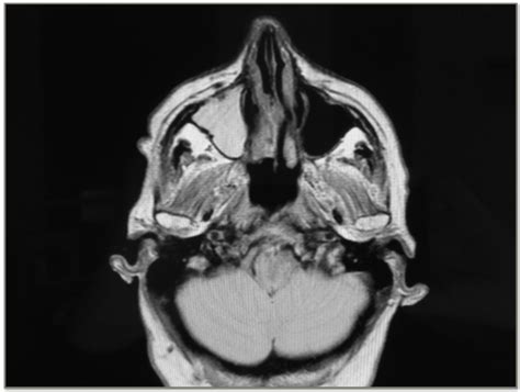 Sinusite Odontogena Sintomatica Trattamento Nella Fess Maurizio G