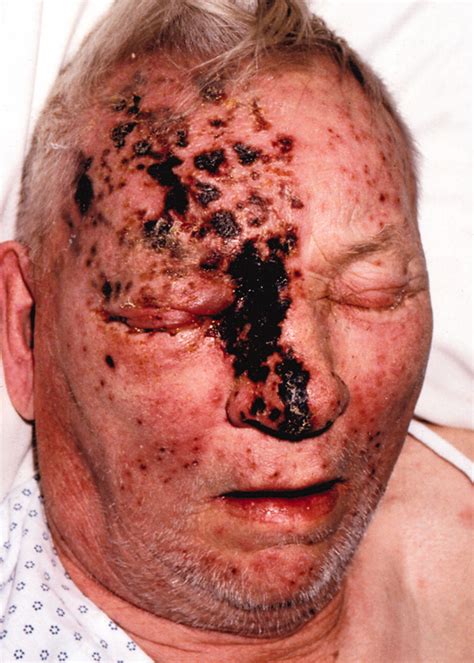 Health And Fitness Shingles And Stress