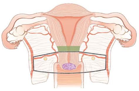 Abdominal Radical Trachelectomy Download Scientific Diagram