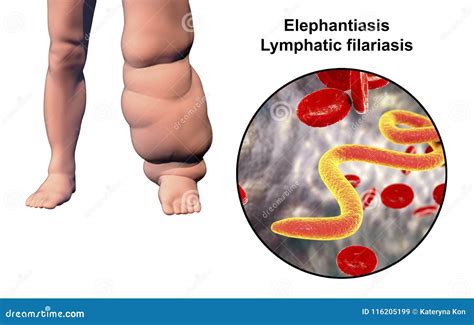 Leg Of A Person With Elephantiasis Lymphatic Filariasis Stock Illustration