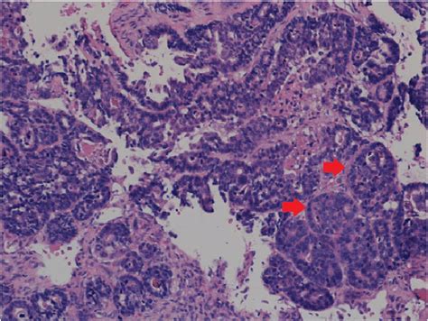 Histology Showing Paraspinal Tissue Replaced And Permeated By