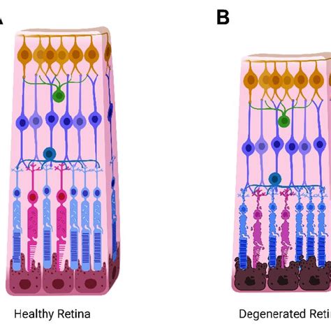 Cartoon Schematic Of A Healthy Retina In Comparison To A Degenerating