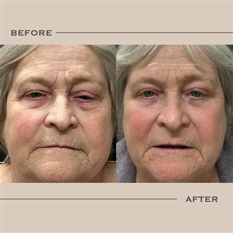 Patient 817962 Lower Blepharoplasty Before And After Photos New York