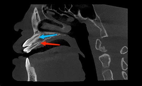 Airway Analysis In Orthodontics How Cbct Supports Better Breathing