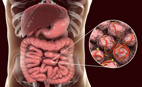 Amoebiasis Causes Symptoms And Treatment