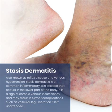 Ankle Discoloration Signs Of Vein Disease