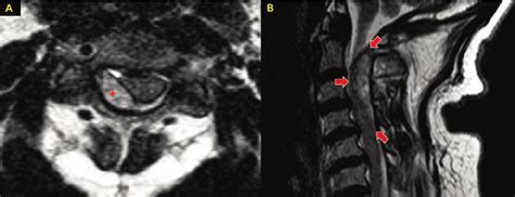 Ct Angiogram Of The Neck And Non Contrast Ct Head A Predominantly Download Scientific Diagram