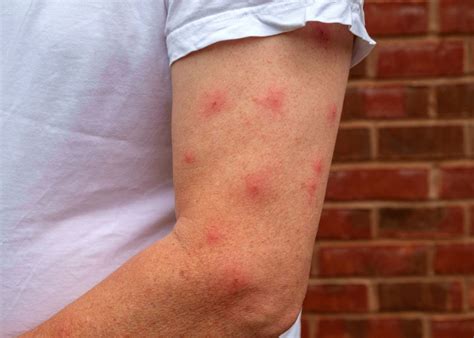 Red Bite Rash