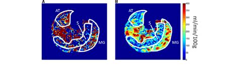 Asl Perfusion Maps Computed Using A Single Pld A And Multiple Plds