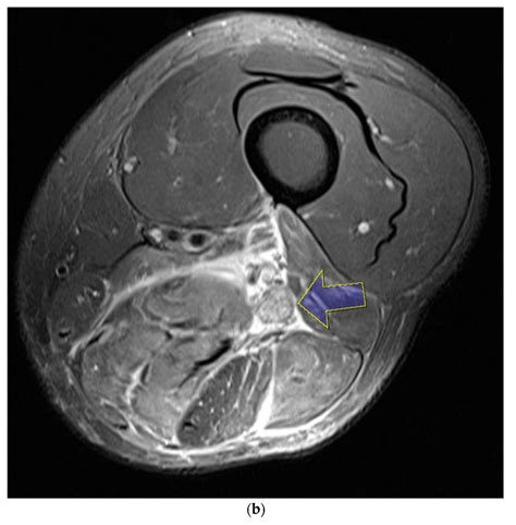 Open Sciatic Nerve Decompression For Compartment Syndrome After