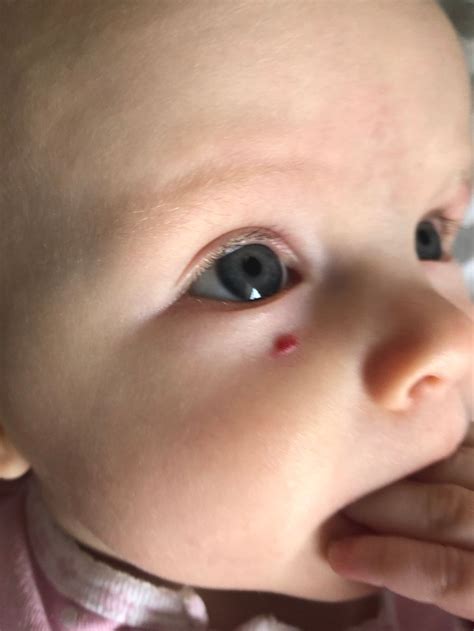 Cherry Hemangioma Infant