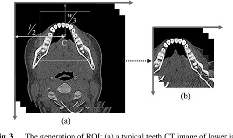 Figure 3 From A Hybrid Segmentation Framework For Computer Assisted Dental Procedures Semantic