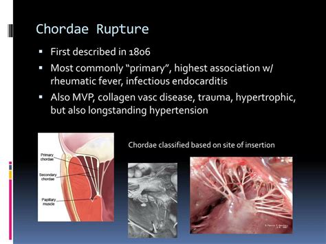 Chordae Tendineae Rupture Treatment