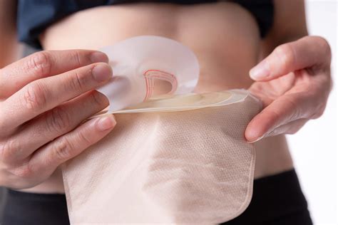 Stoma Care Nursing Services In Melbourne Ability Aid Support