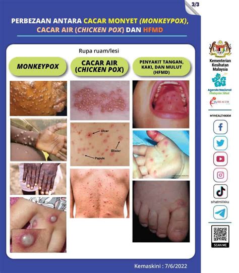 Monkeypox Simptom And Risiko Jangkitan Mpox Di Malaysia
