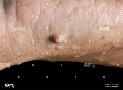 Neurofibromatosis Neurofibroma Growths On The Skin Of A Year Old Woman With
