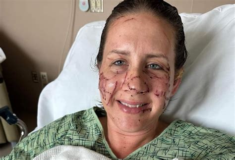 Victim Opens Up About Vicious And Relentless Otter Attack Outdoors