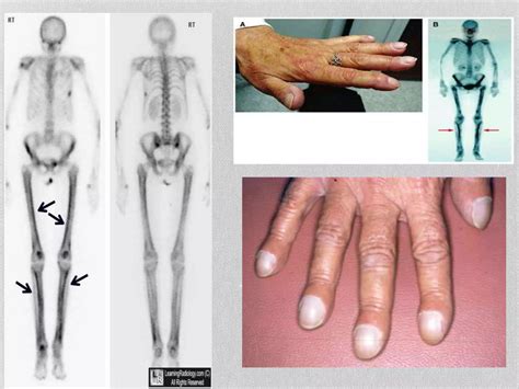 Para Neoplastic Malignant Syndromes Ppt Free Download
