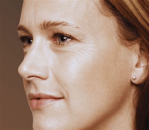 How To Treat Crows Feet A Complete Guide To Prevention And Treatment