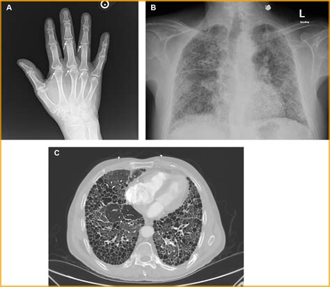 Interstitial Lung Disease X Ray