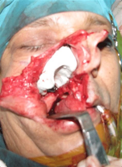 First Part Of The Putty Elastomer Obturator Including Nasal Airway