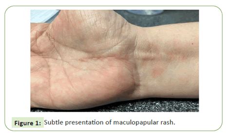 Prevalence And Incidence Of Infectious Neuropathies In A Populat