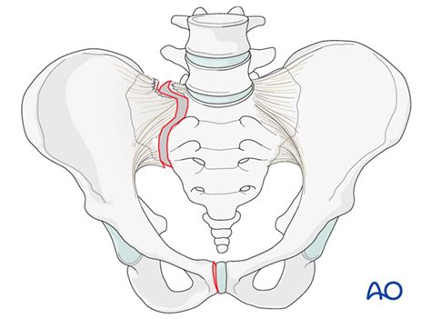 Si Joint Fractures