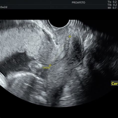 Avaliação Do Colo Uterino