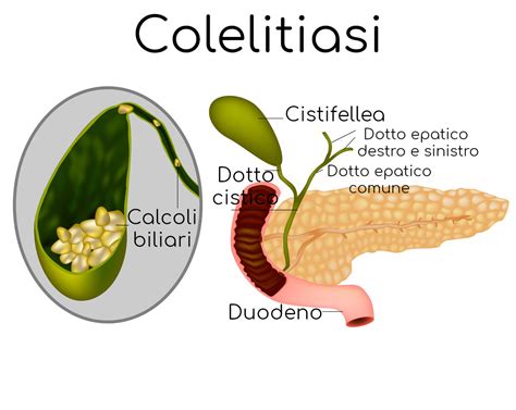 Calcoli Biliari Cause E Sintomi Calcoli Biliari Epatici Xaky