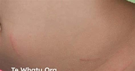 Plant Dermatitis Image