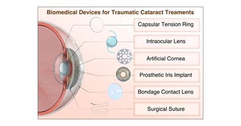 Traumatic Cataract