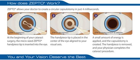 Going Beyond Laser Griffin Eye Centeryour 1 Destination For Vision