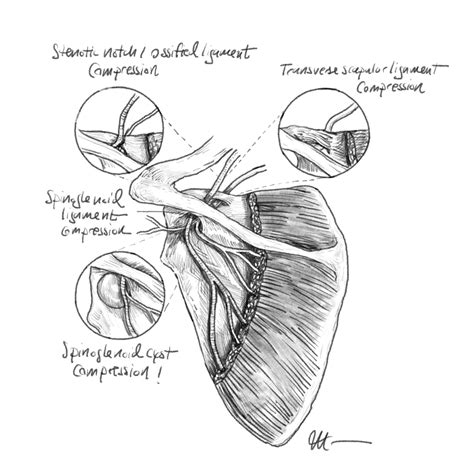 The Common Sites Of Suprascapular Nerve ทรงไทย จริงจริ๊ง Facebook