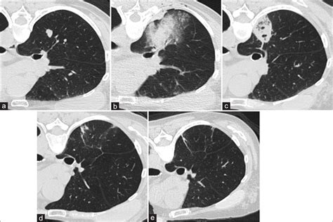 Thermal Ablation For Local Control Of Lung Metastases And Its Effect On Pulmonary Function