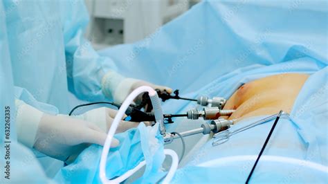 Close Up Of Hands Of Surgeons Team During Operation Uterus Removal With