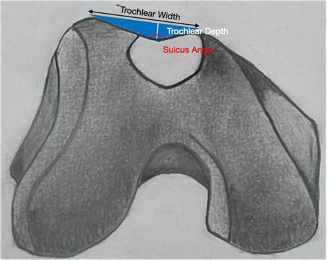 Trochlear Morphology In Healthy People Implications For Osteochondral Allograft Transplantation