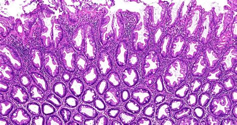 Hyperplastic Polyp Hyperplastic Polyp Photos And Images Shutterstock