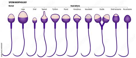 Normal And Head Defects Spermatozoon Semen Analysis Vector Sperm